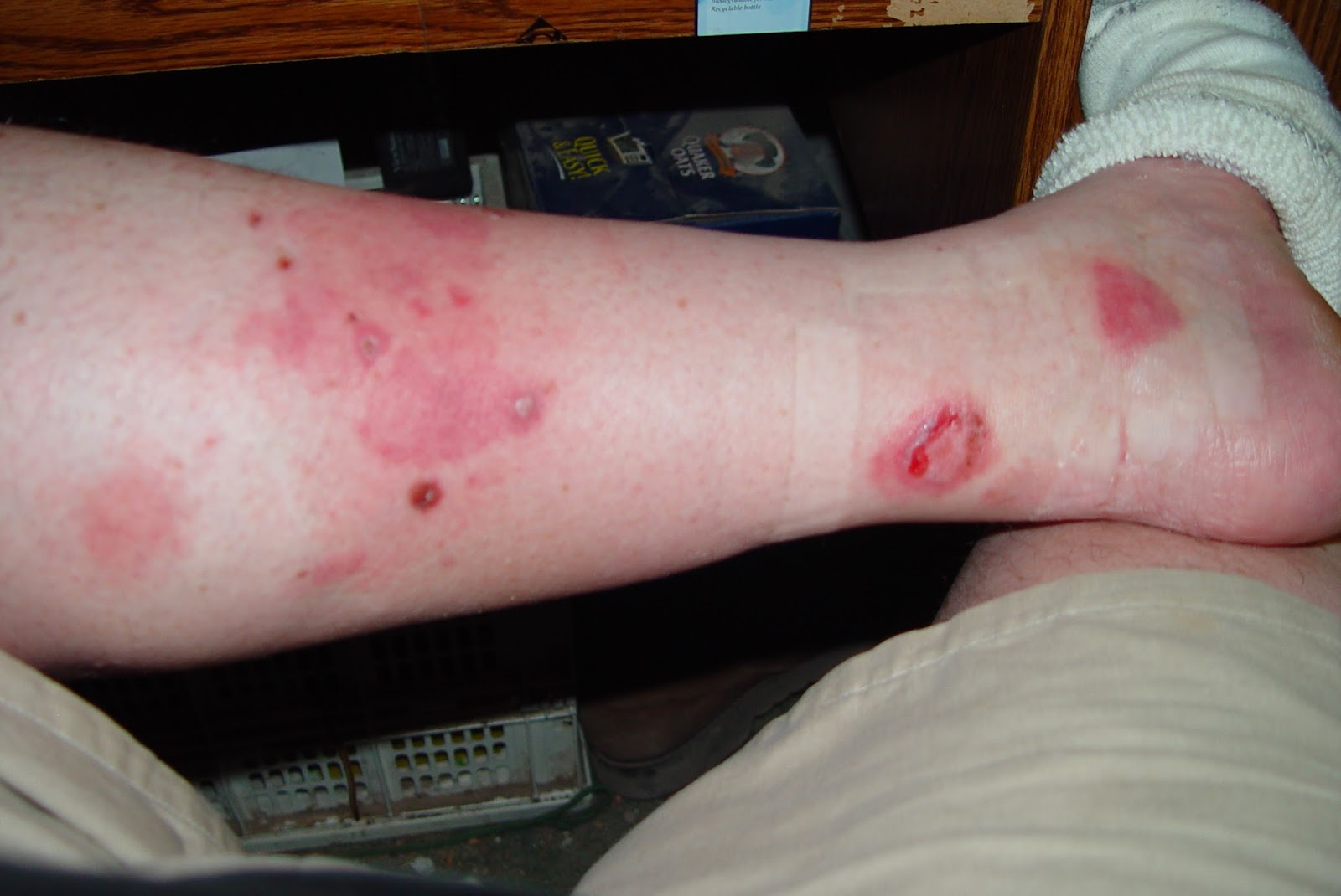 Big Pine: SPIDER BITE