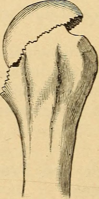 Técnicas específicas de fisioterapia en las fracturas del hombro