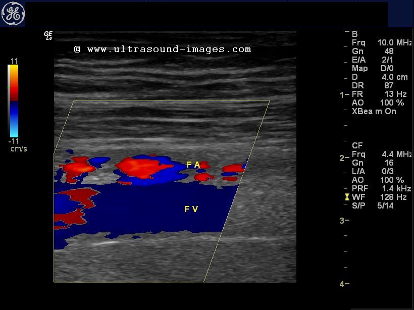 cochinblogs: Ultrasound imaging of popliteal vein thrombosis