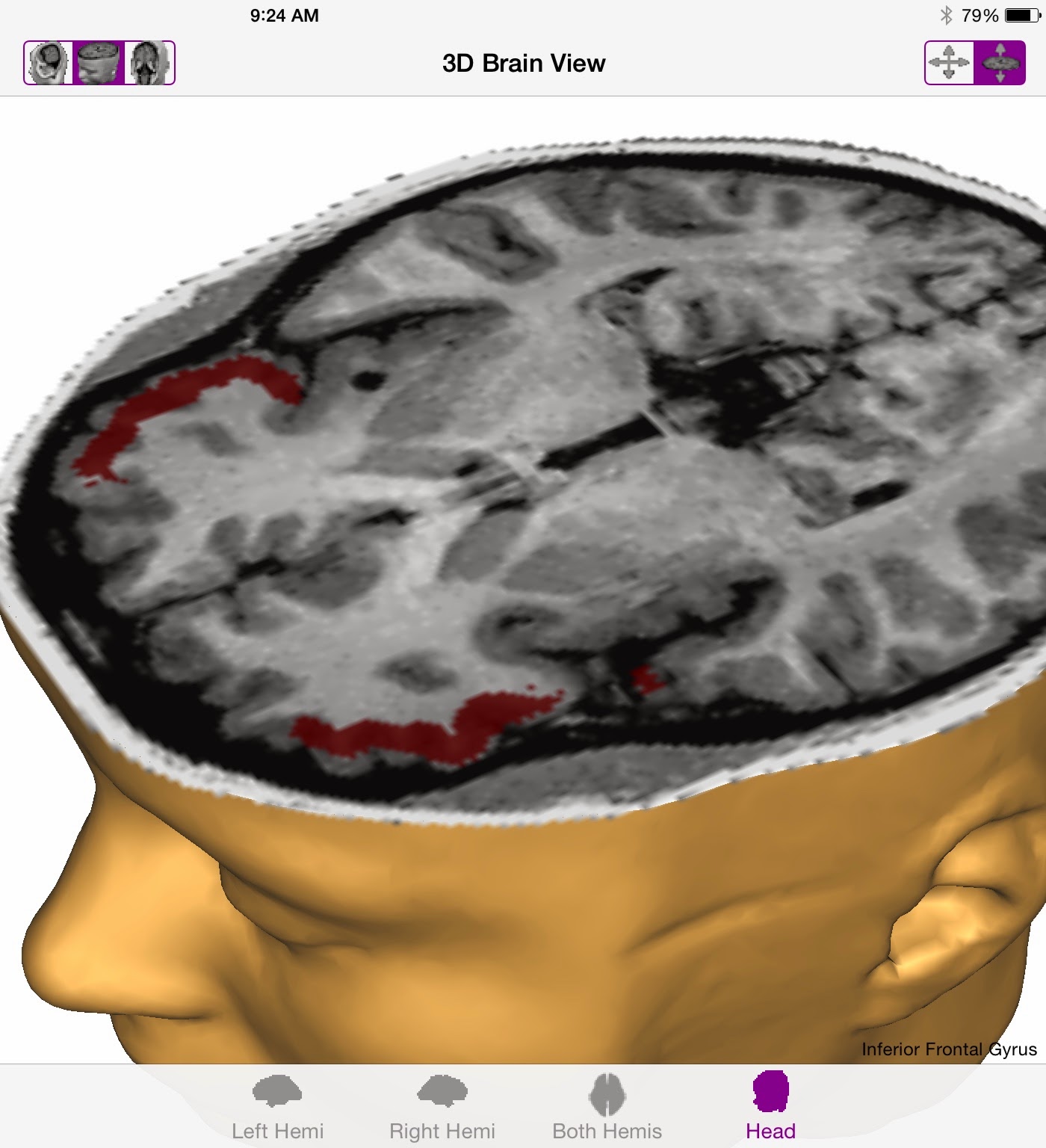 Anorexia Nervosa: Brain Connectivity Abnormalities - ILMB