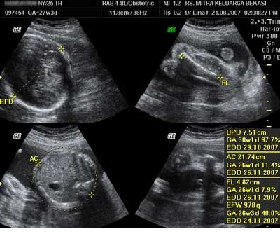 All about Medical Physics: USG (Ultrasonography)