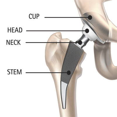 Tom's Physiotherapy Blog: Surgery to the Hip