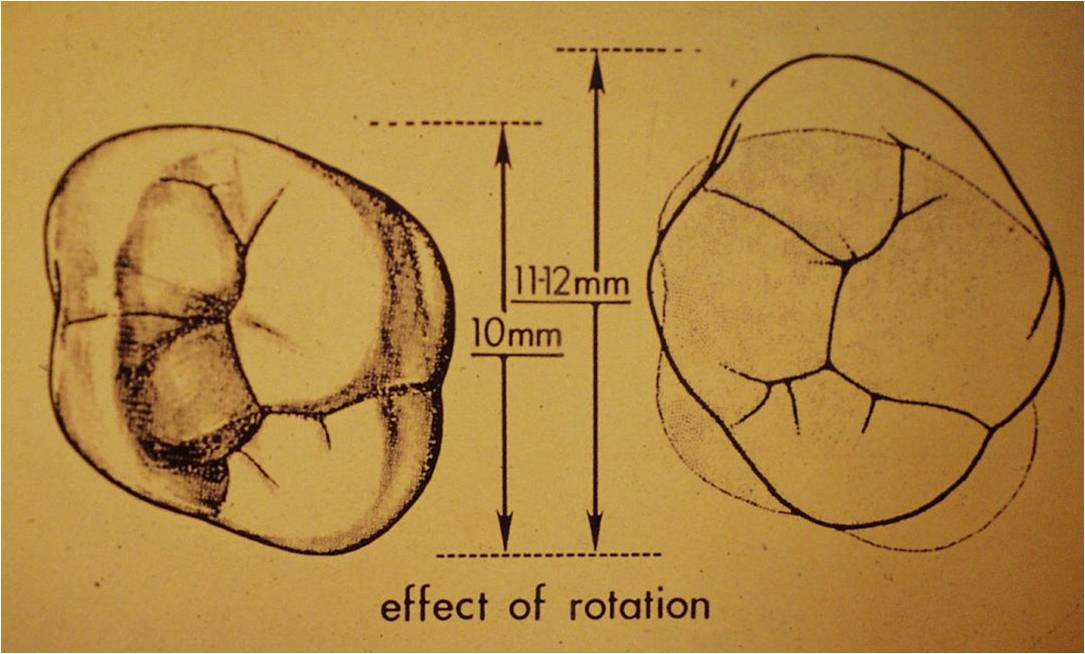 practical orthodontics: Diagnosis and treatment of mesially rotated ...