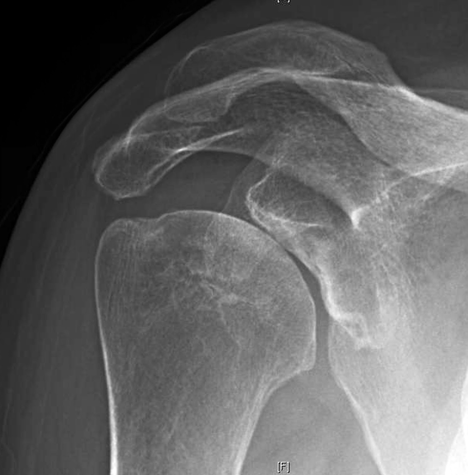 UW Shoulder and Elbow Academy: Shoulder joint replacement arthroplasty ...