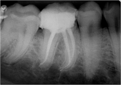 Davini - Endodontia e Microscopia Operatória: Tratamento endodôntico ...