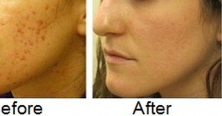 How to Get Smooth Skin after Old Acne Scars - Beauty And Skin