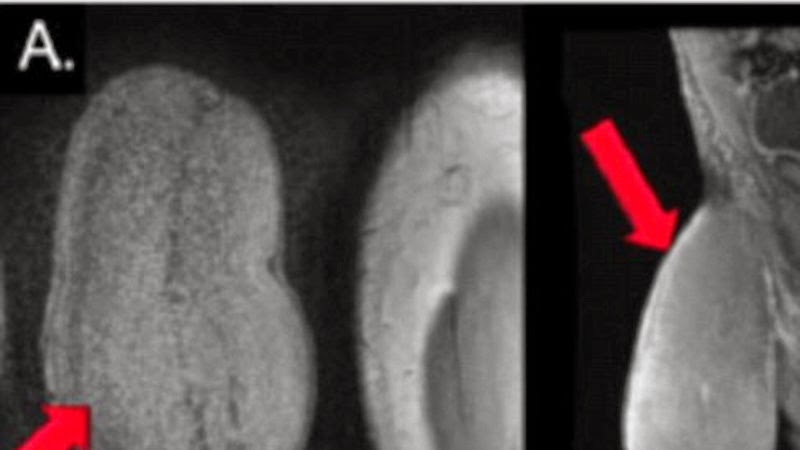 FOCH: Pierwsza na świecie operacja ZMNIEJSZENIA penisa
