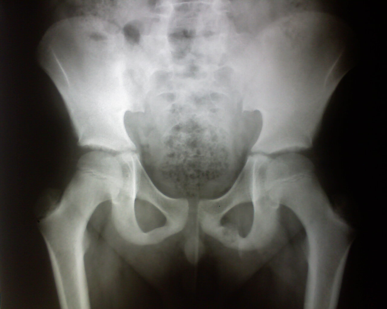 POINT OF VIEW: CASE 29: 5 y/o male with left hip pain
