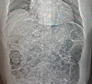 GastroenterologyOnline: Air bubbles everywhere in the abdomen