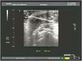 VIETNAMESE MEDIC ULTRASOUND: CASE 313: FISH BONE APPEARING in NECK, Dr ...