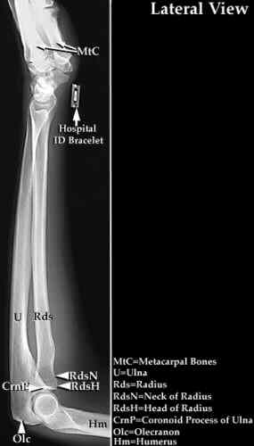 Radiographic positioning: Lateral forearm