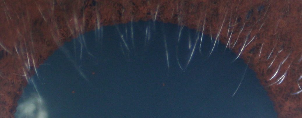 Modern & Multidimensional Iridology: Persistence Pupillary Membrane - PPM