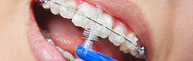 Damon Clear Braces - My journey: Cleaning Routine