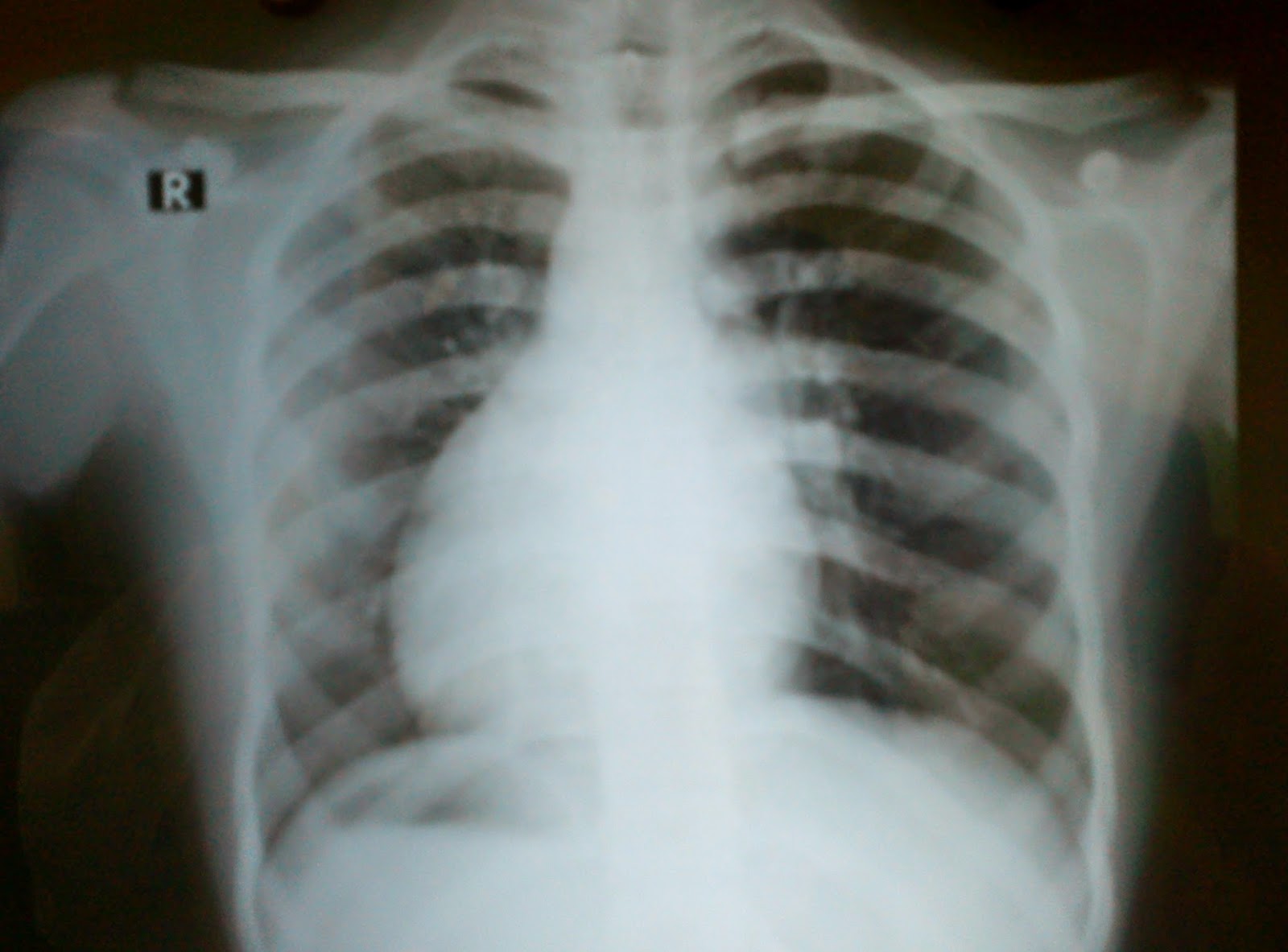 HealthforHeart: Situs inversus dextrocardia associated corrected ...