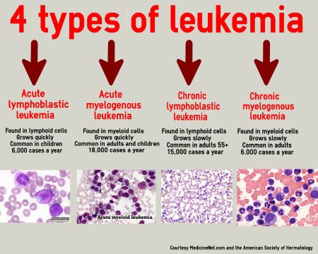 KSJBIO: #80 Leukemia (English)