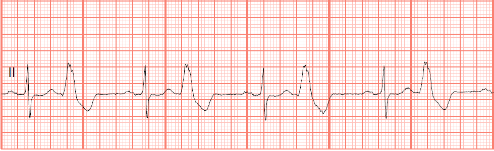 Basic EKG Test 71