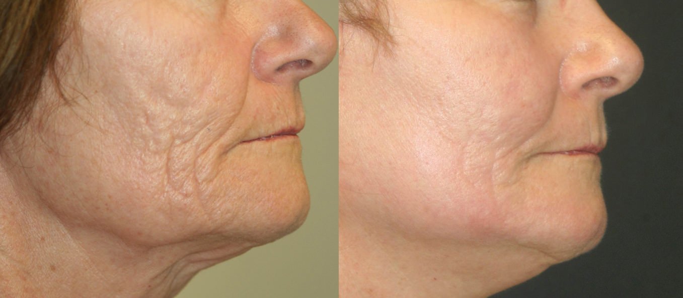 Best Acne Scars Treatment Products: How The Acne Scars Are Treated ...