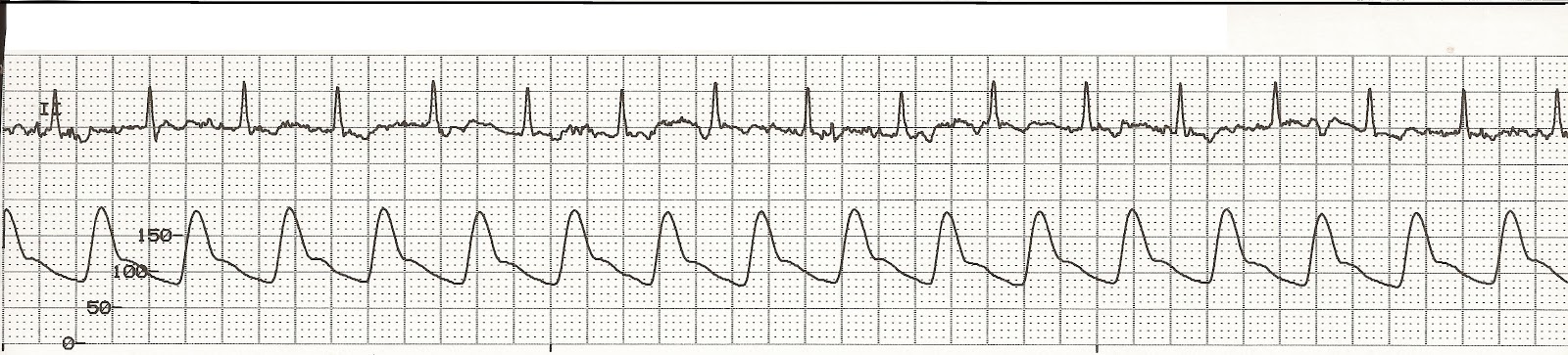 Various rhythms with arterial blood pressure waveform