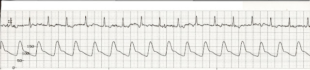 Various rhythms with arterial blood pressure waveform