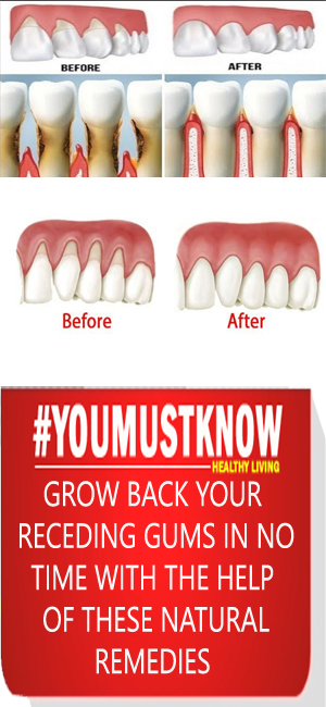 Grow Back Your Receding Gums In No Time With The Help Of These Natural Remedies
