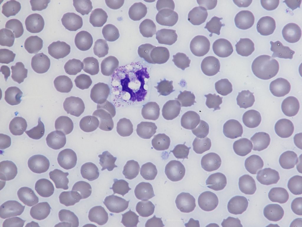 FICHERO DE HEMATOLOGIA : ANORMALIDADES DE LOS NEUTROFILOS
