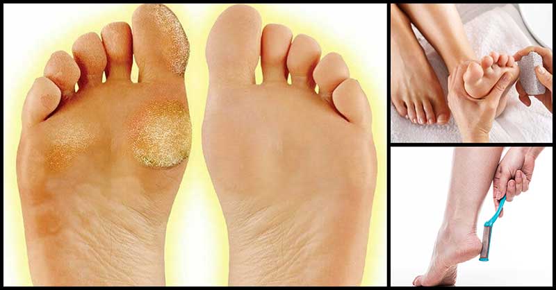 How to Get Rid of Calluses | Dr Farrah MD