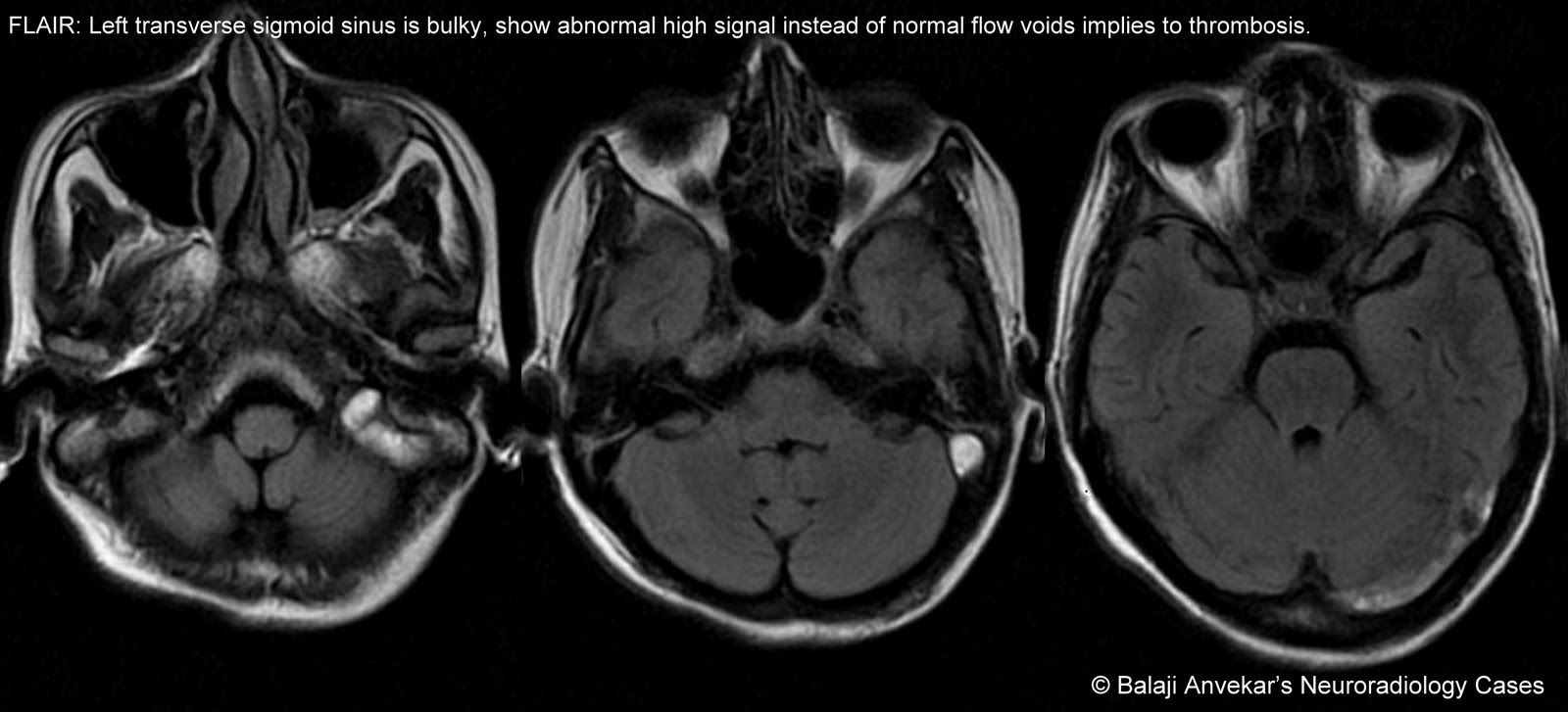 Dr Balaji Anvekar FRCR: Hypoplastic transverse sinus MRI