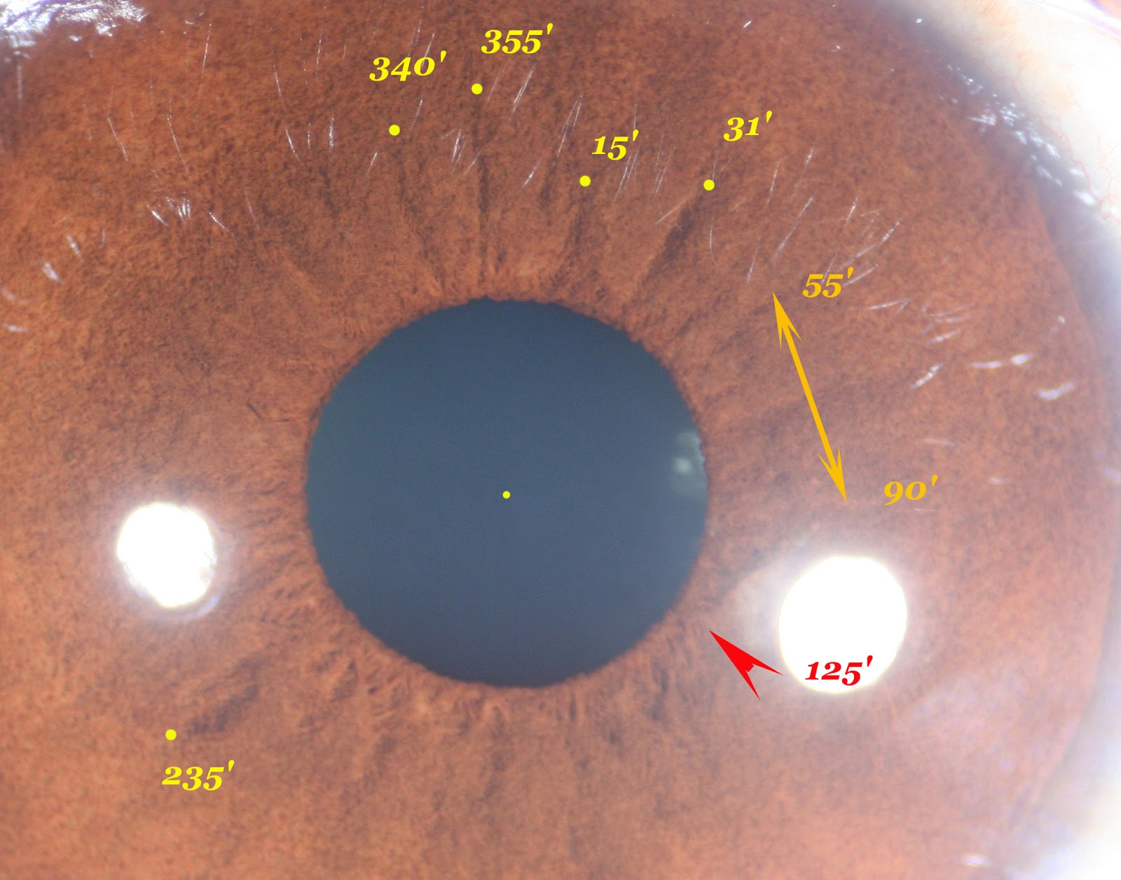 Modern & Multidimensional Iridology: Mammilations, Radial Furrows & The ...