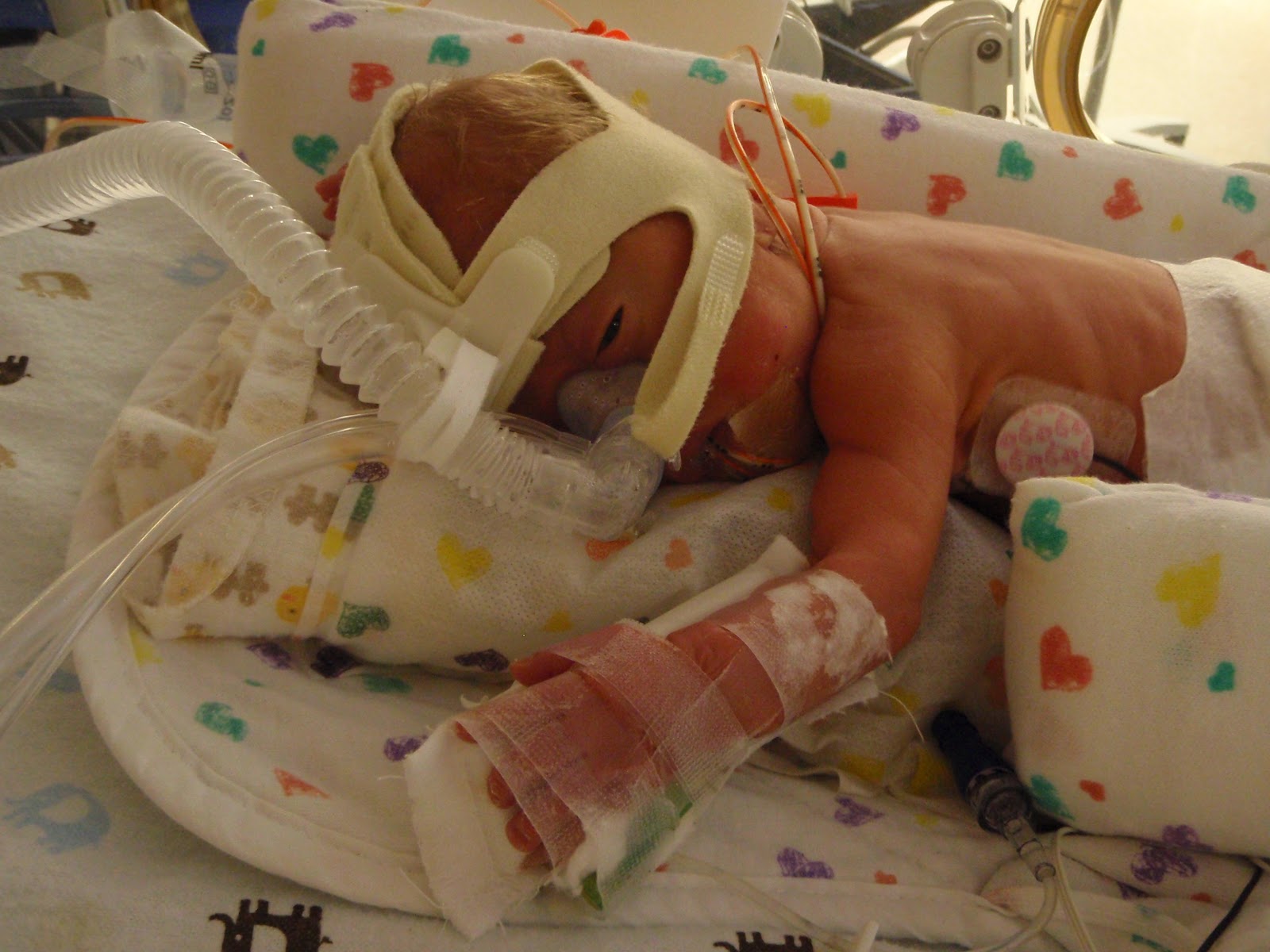 Connor Twins: Oxygen for the babies