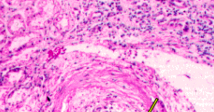 腎脂肪塞栓症 (Renal Atheroembolism, Cholesterol Crystal Emboli )