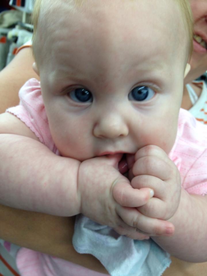 Renae's journey with Trigonocephaly Metopic Craniosynostosis.: What is ...