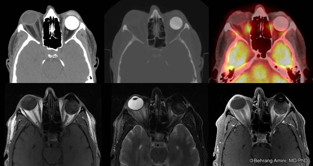 Roentgen Ray Reader: Hydroxyapatite Ocular Implants