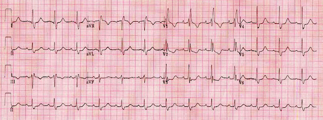 EM Didactic: The "qRBBB" pattern