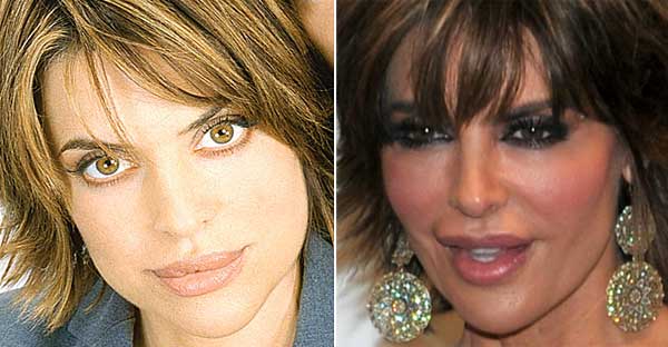 Lisa Rinna Plastic Surgery Before and After Botox and Breast ...