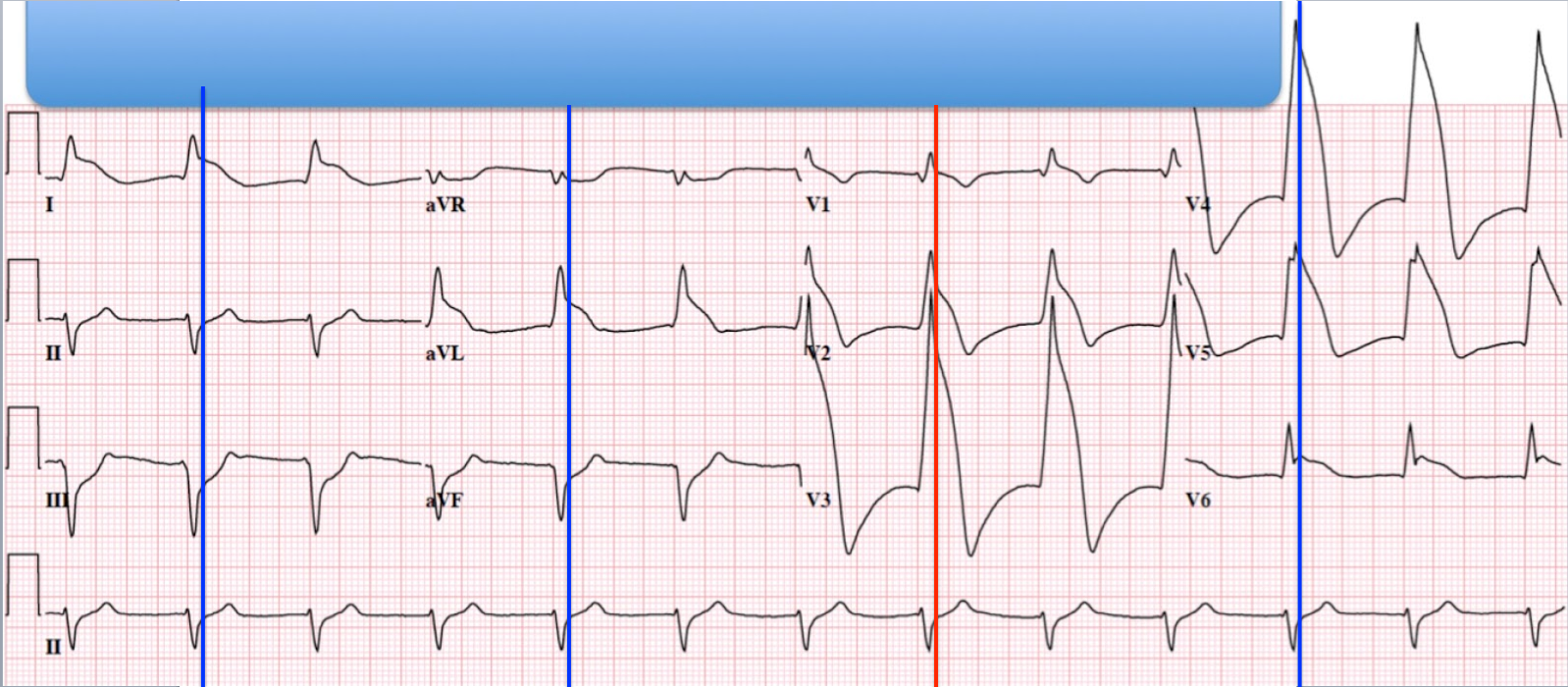 Dr. Smith's ECG Blog: Giant R-waves. What are they?