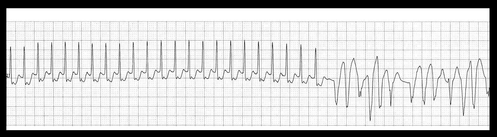 Practice EKG Strips 332