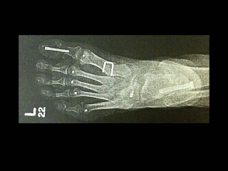 Foot Surgery for CMT: 4 Months P.O. - An Update and An Apology...
