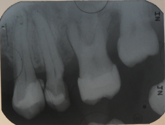 CLASIFICACIÓN DE LAS ENFERMEDADES Y CONDICIONES PERIODONTALES ...
