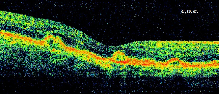 DEGENERACION MACULAR : DRUSAS y OCT
