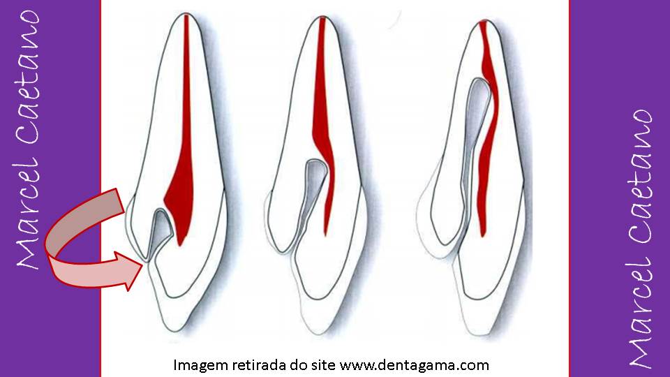 Endodontia Avançada: Dens in dente - Um desafio para o Endodontista.