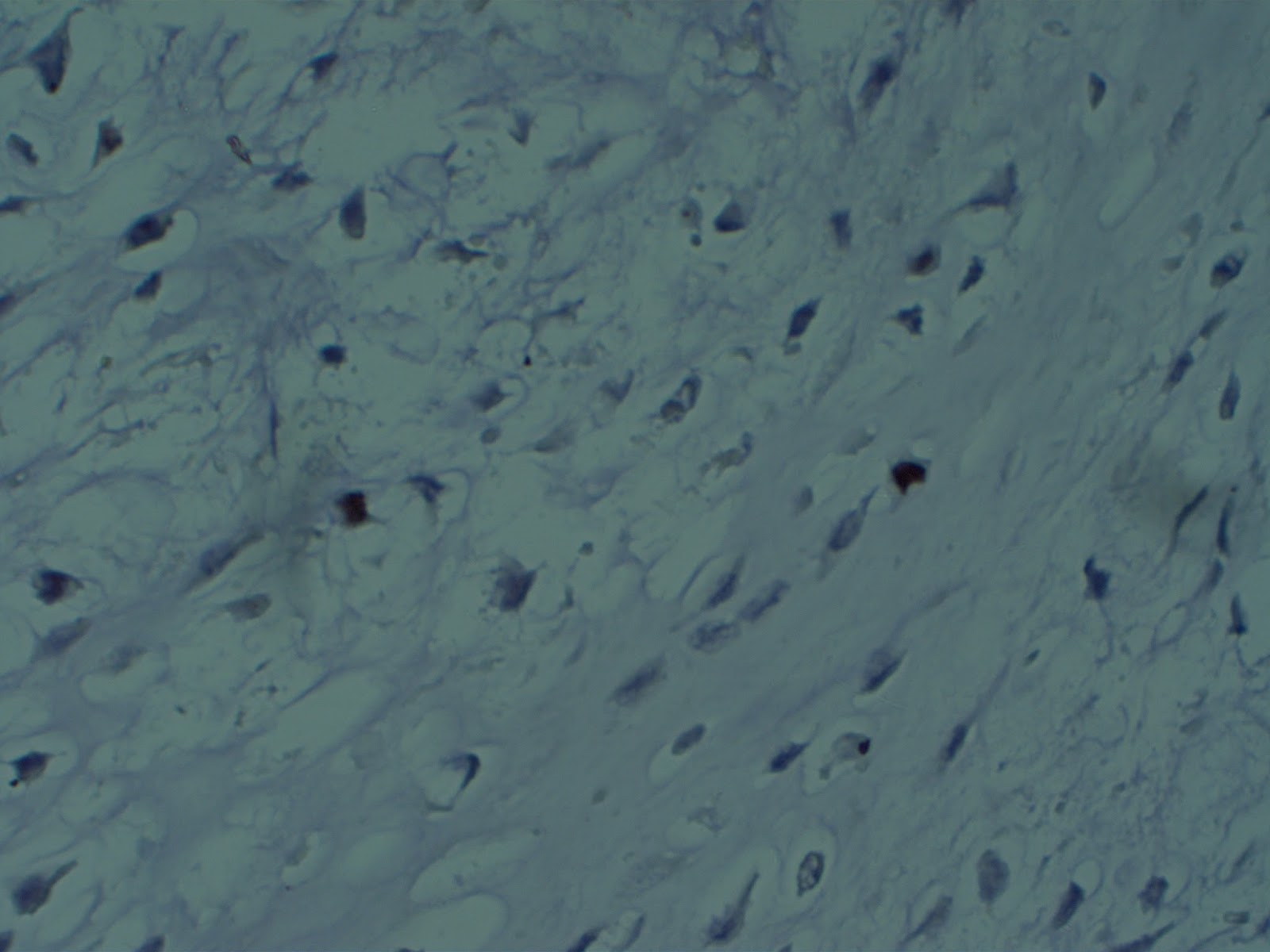 dr pankaj goel: Chondrosarcoma of the Sternum- Radical Excision and ...