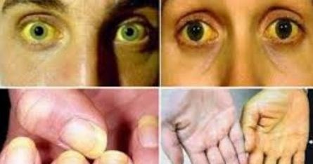 Pengertian Penyakit Kuning | Air Milagros Bekasi 08128445040