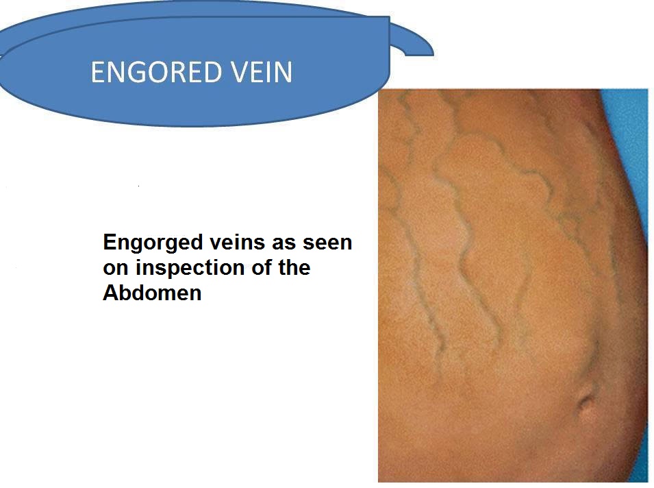 Study Medical Photos: Engorged Abdominal Veins And Determining The ...