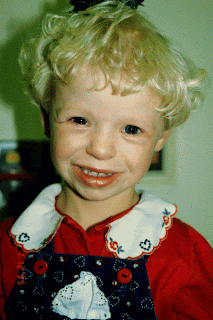 Williams syndrome: A rare genetic disease