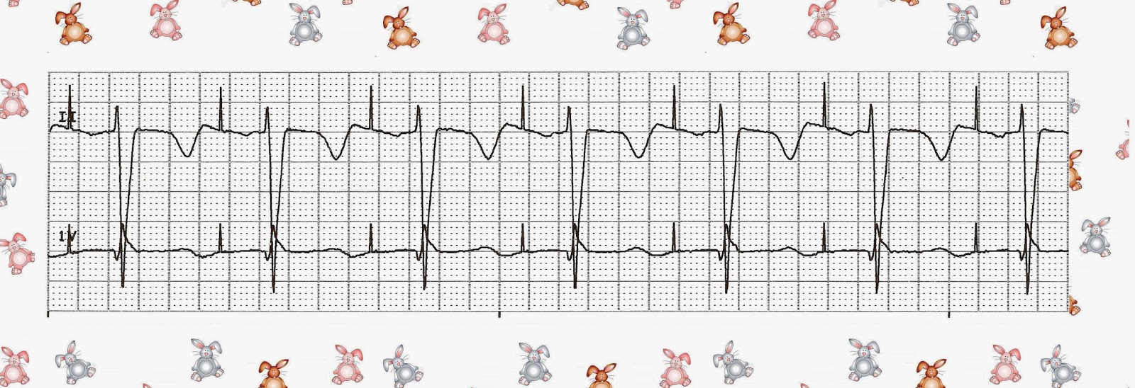EKG Rhythm Strips Easter 2014