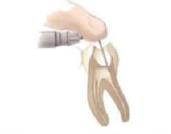 Técnicas de anestesia local en odontología: Infiltración intrapulpar