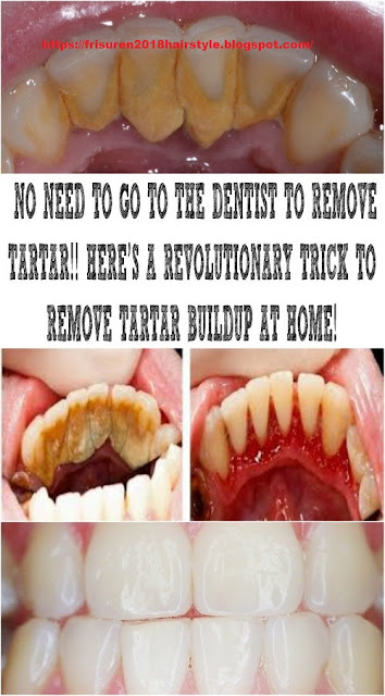 NO NEED TO GO TO THE DENTIST TO REMOVE TARTAR!! HERE’S A REVOLUTIONARY ...