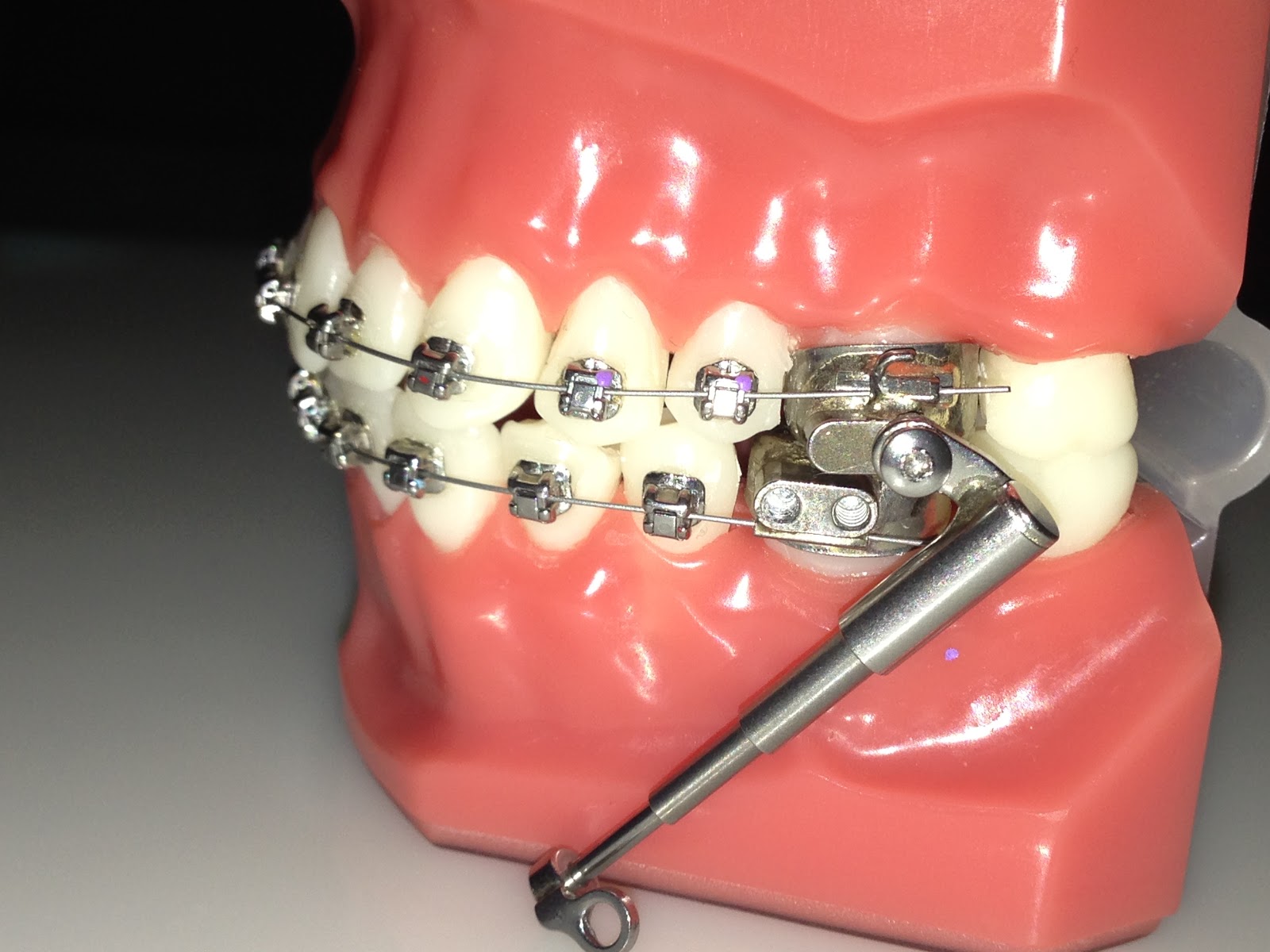 ORTODONCIA INVISIBLE HABIB BARHOUM: ADVANSYNC 2 - ORMCO