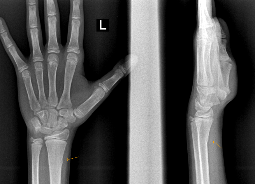 Torus Fracture-Radius - Sumer's Radiology Blog