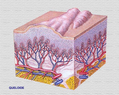 Queloide - Geri e Derme Beauty